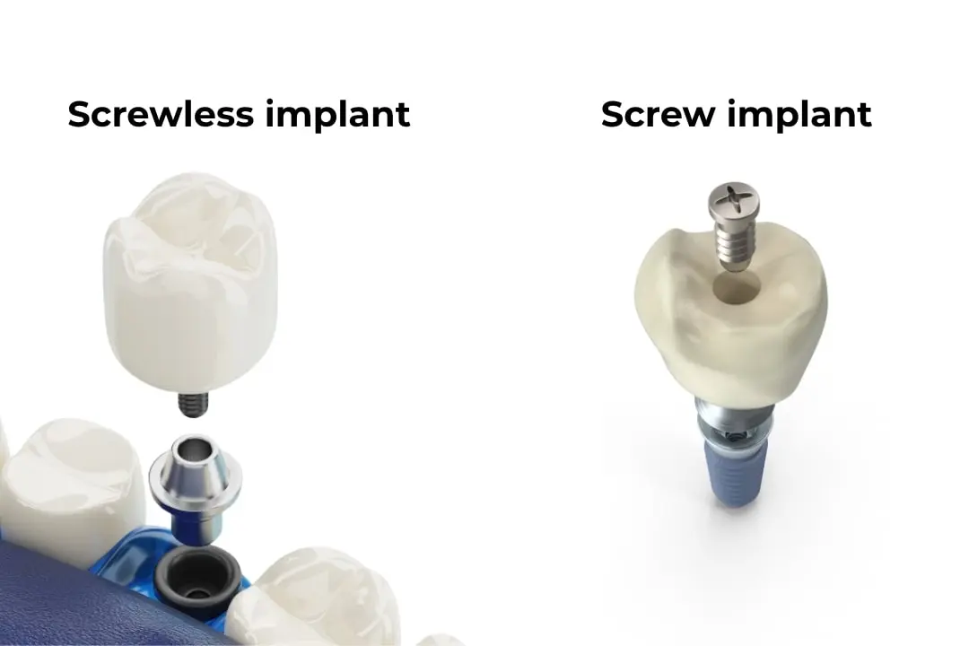 Screwless Dental Implants Turkey: Screwless or Screwed?
